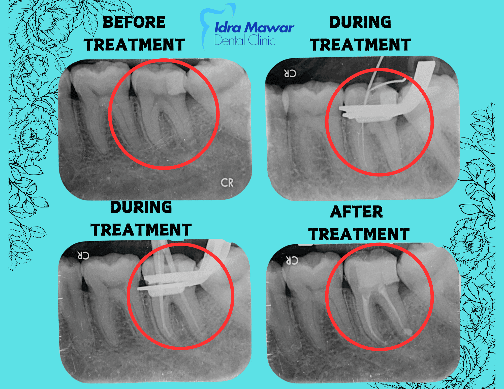 Essential Post-Care Tips After Your First Root Canal Treatment